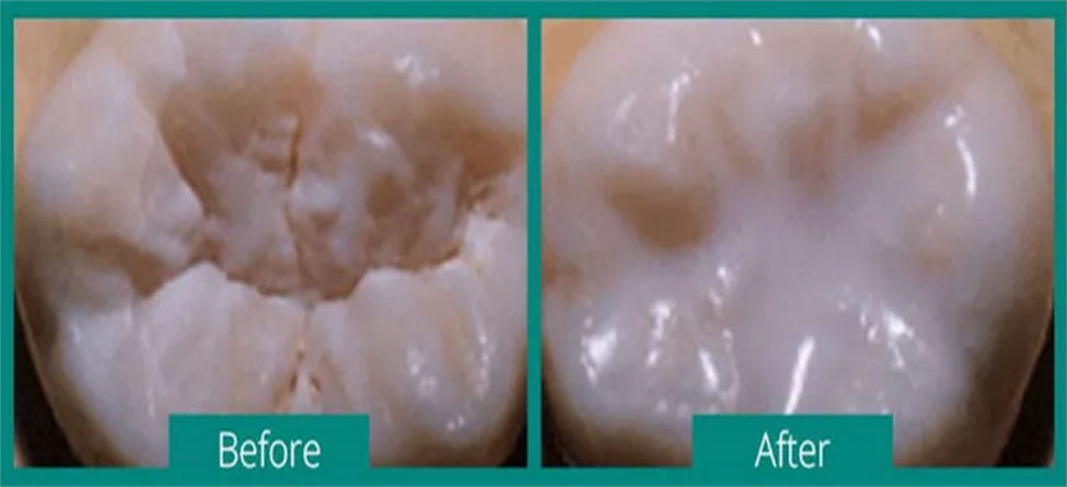 Before-and-After-Dental-Sealant - Dentistry of the Carolinas